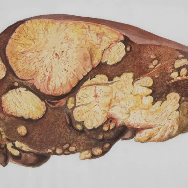 Colitis infecciosa: causas, síntomas y tratamiento